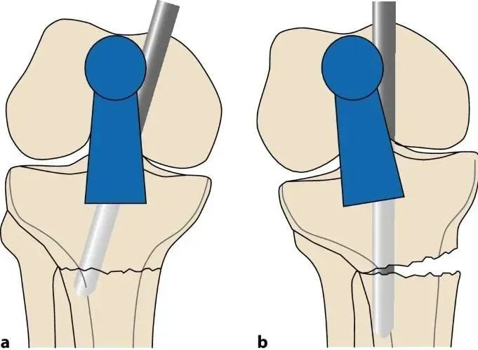 Fractura tibial, técnica de enclavado intramedular suprapatelar ...